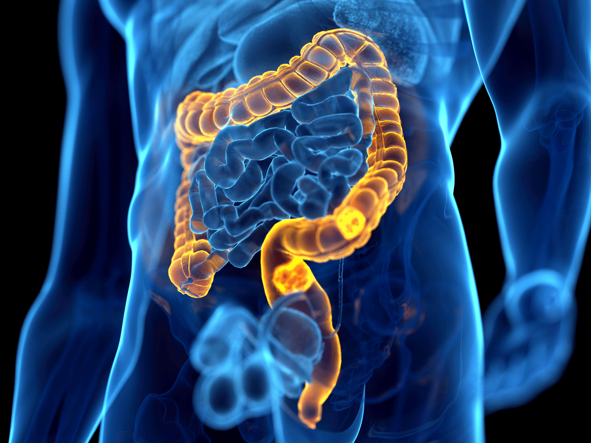 Your Chances for Recovery from Colon (Colorectal) Cancer ...