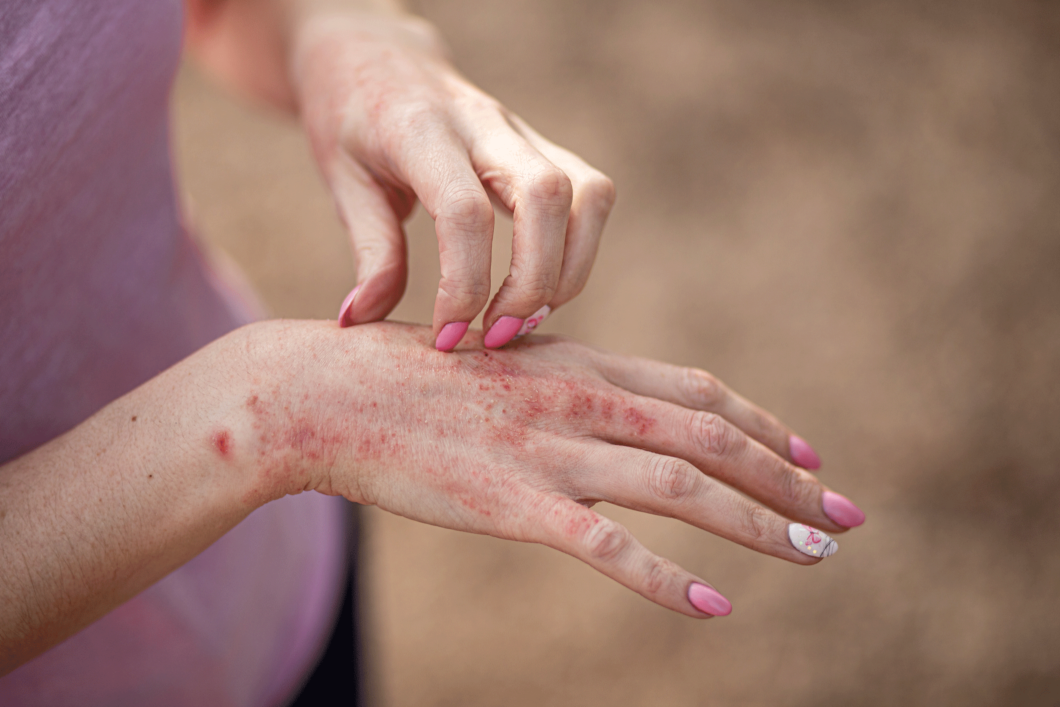 What Is Dermatitis? | YourCareEverywhere